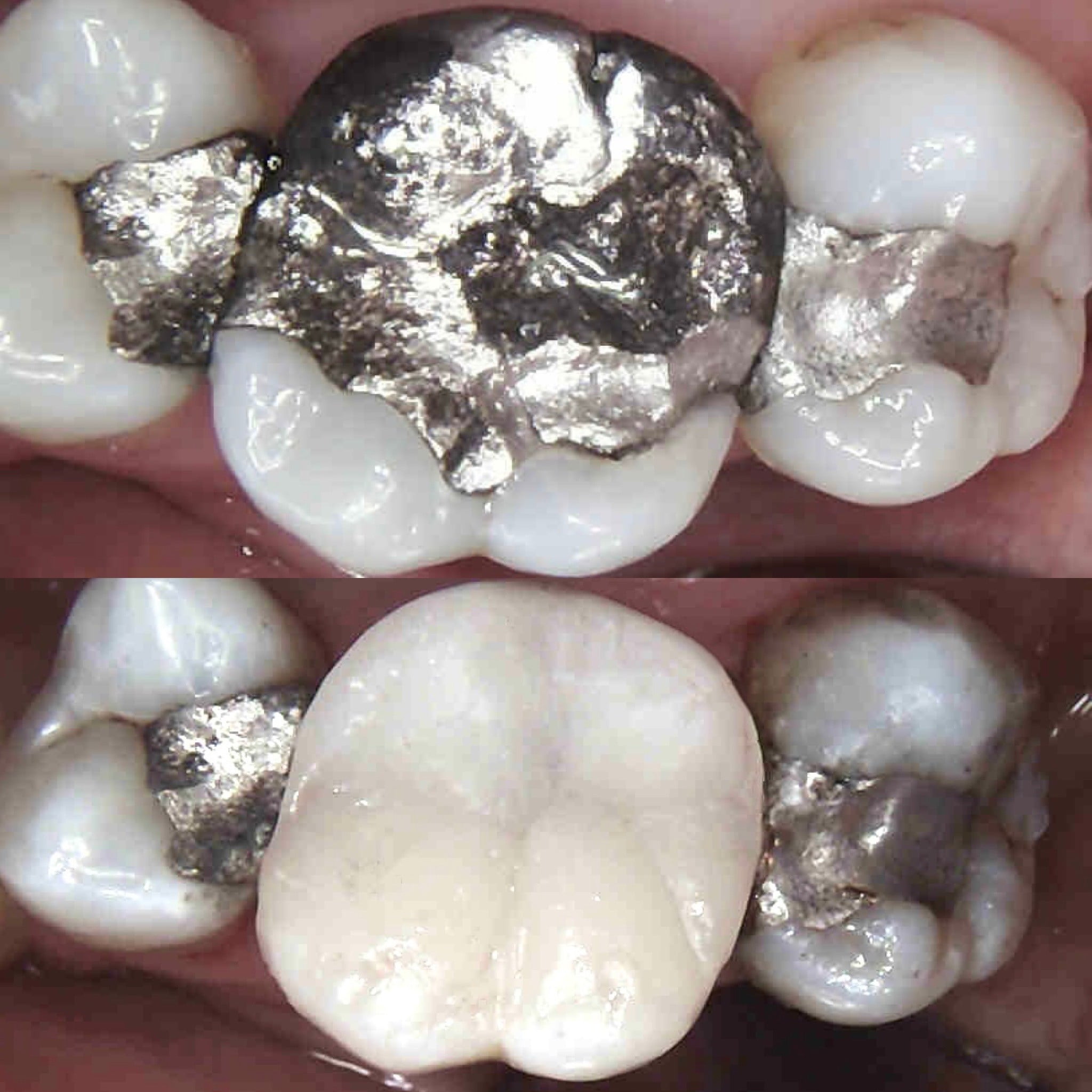 Composite Filling Burgess Hill - White Tooth Fillings